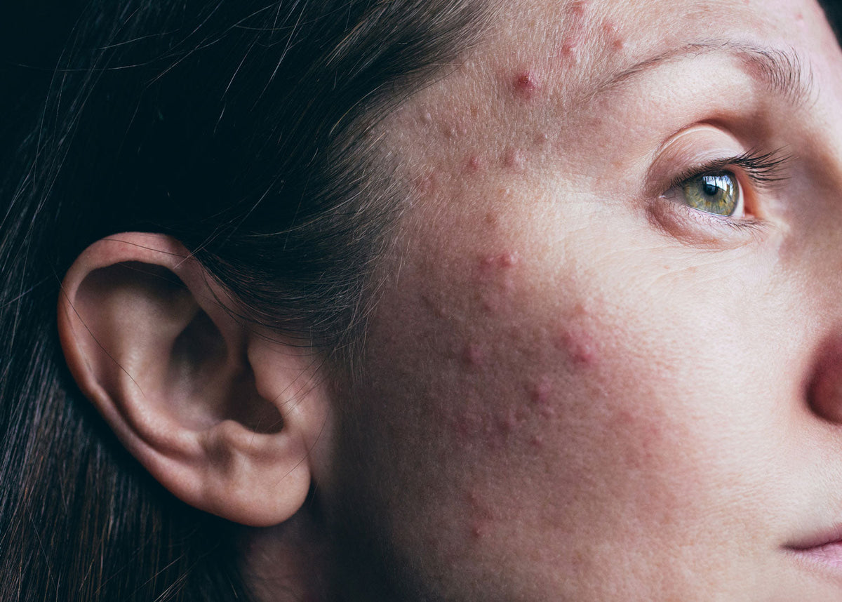 Acné du visage : causes, symptômes et solutions – Twenty DC